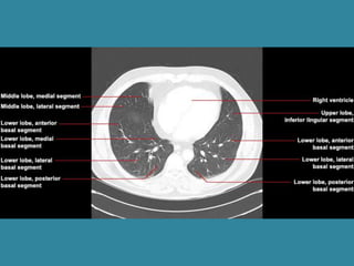 Anatomy of chest | PPTX