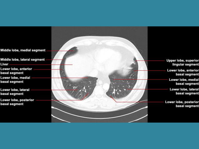 Anatomy of chest | PPTX