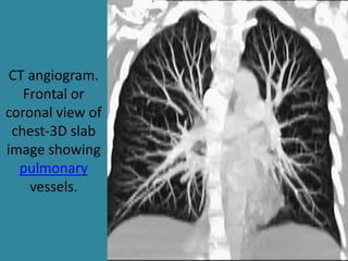 Anatomy of chest | PPTX