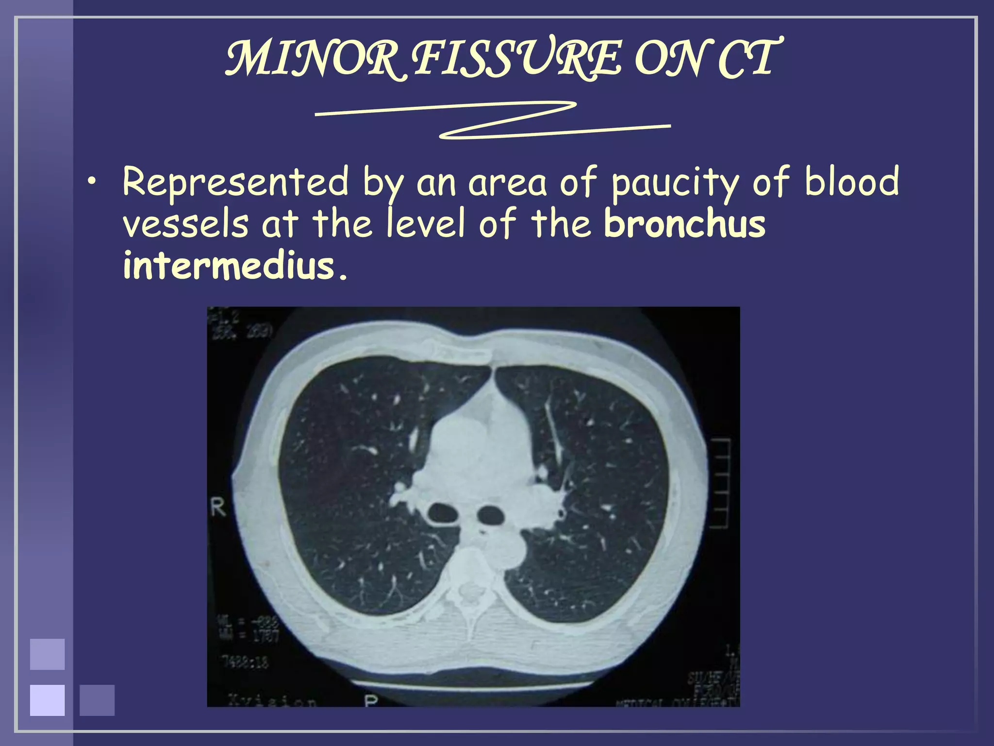 radiology anatomy of chest.ppt