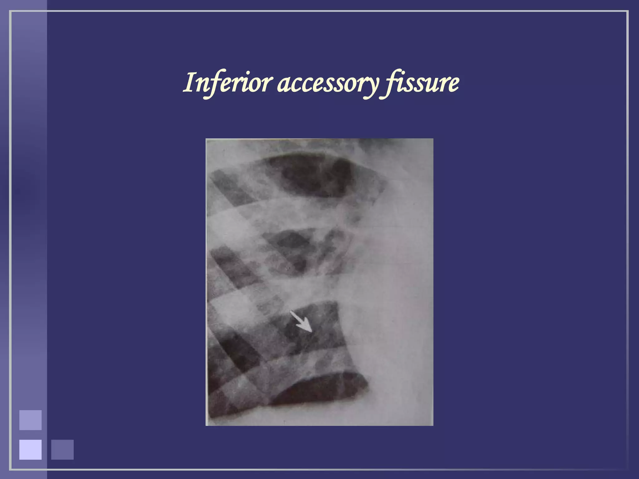radiology anatomy of chest.ppt