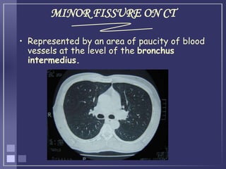 radiology anatomy of chest.ppt