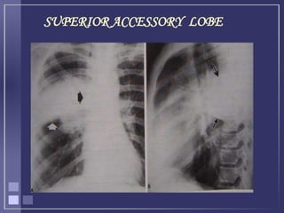 radiology anatomy of chest.ppt