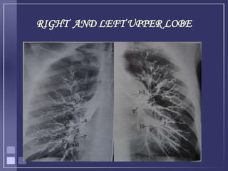 radiology anatomy of chest.ppt