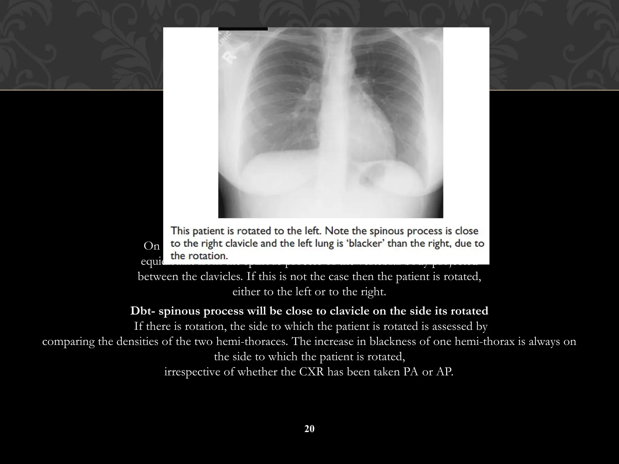 anatomy of chest in radiograph radiology.ppt