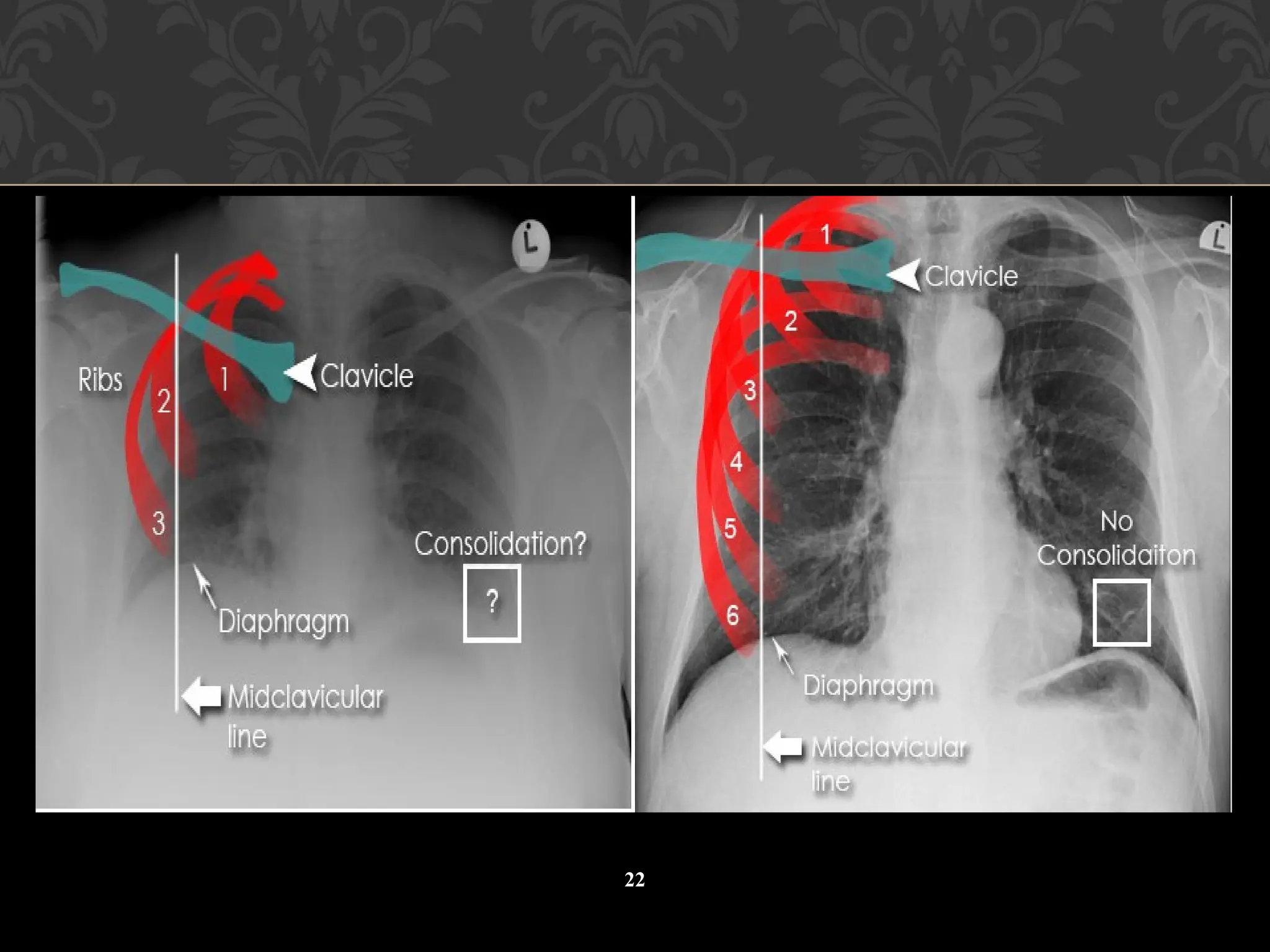 anatomy of chest in radiograph radiology.ppt
