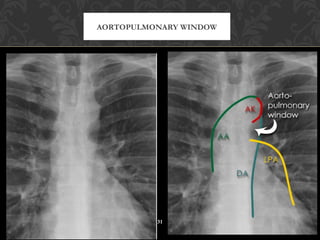 anatomy of chest in radiograph radiology.ppt