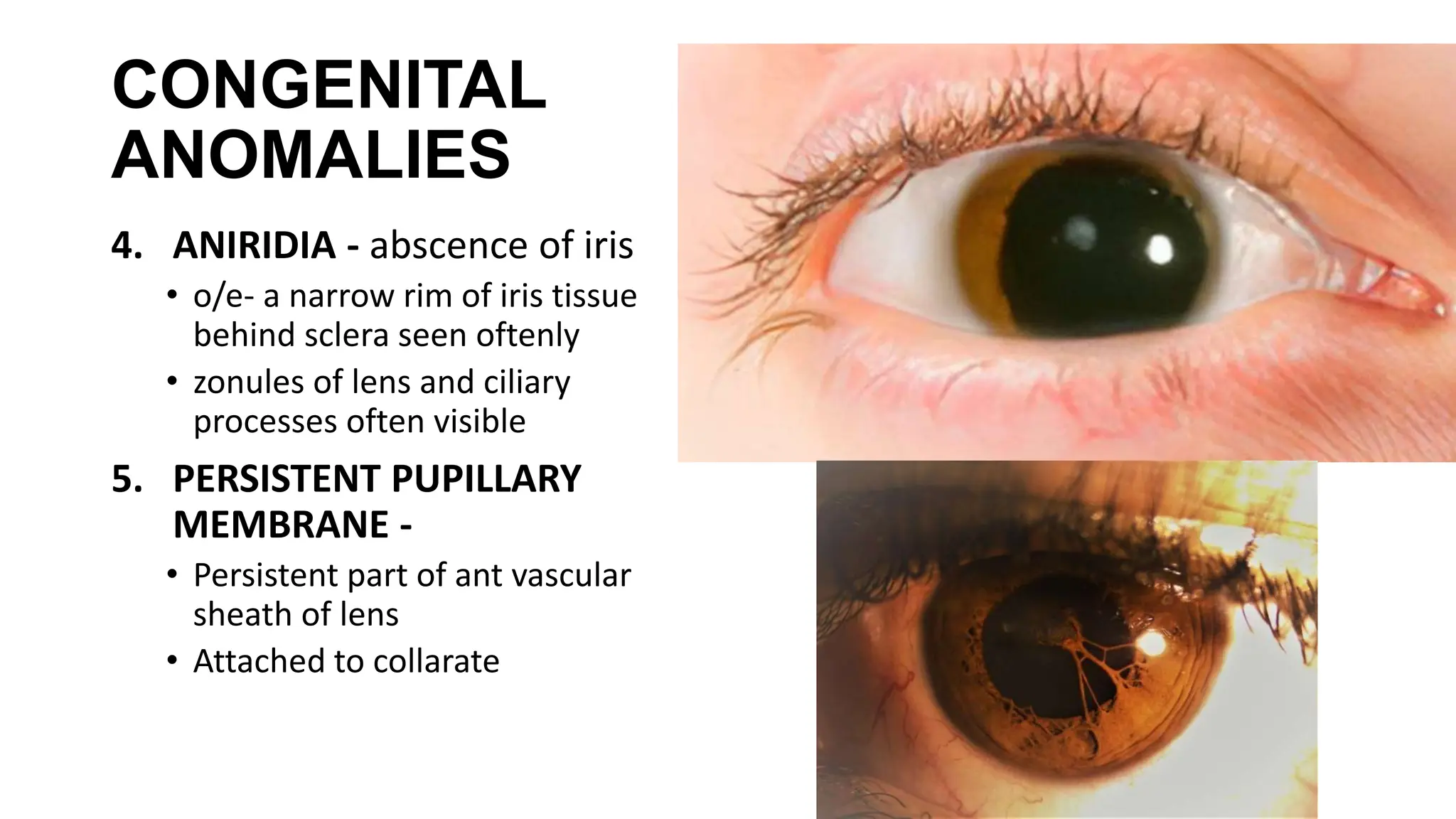 ANATOMY OF CILIARY BODY, IRIS AND CHOROID.ppt