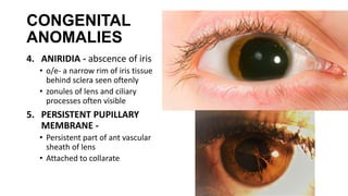 ANATOMY OF CILIARY BODY, IRIS AND CHOROID.ppt