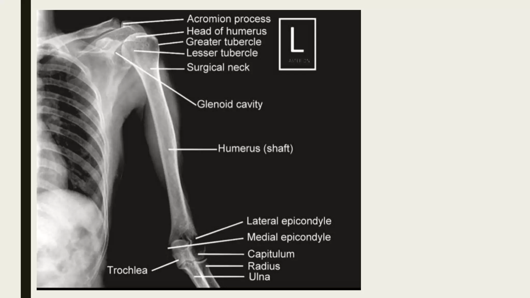 Anatomy Of Clavicle Normal copy (1) (1).pptx