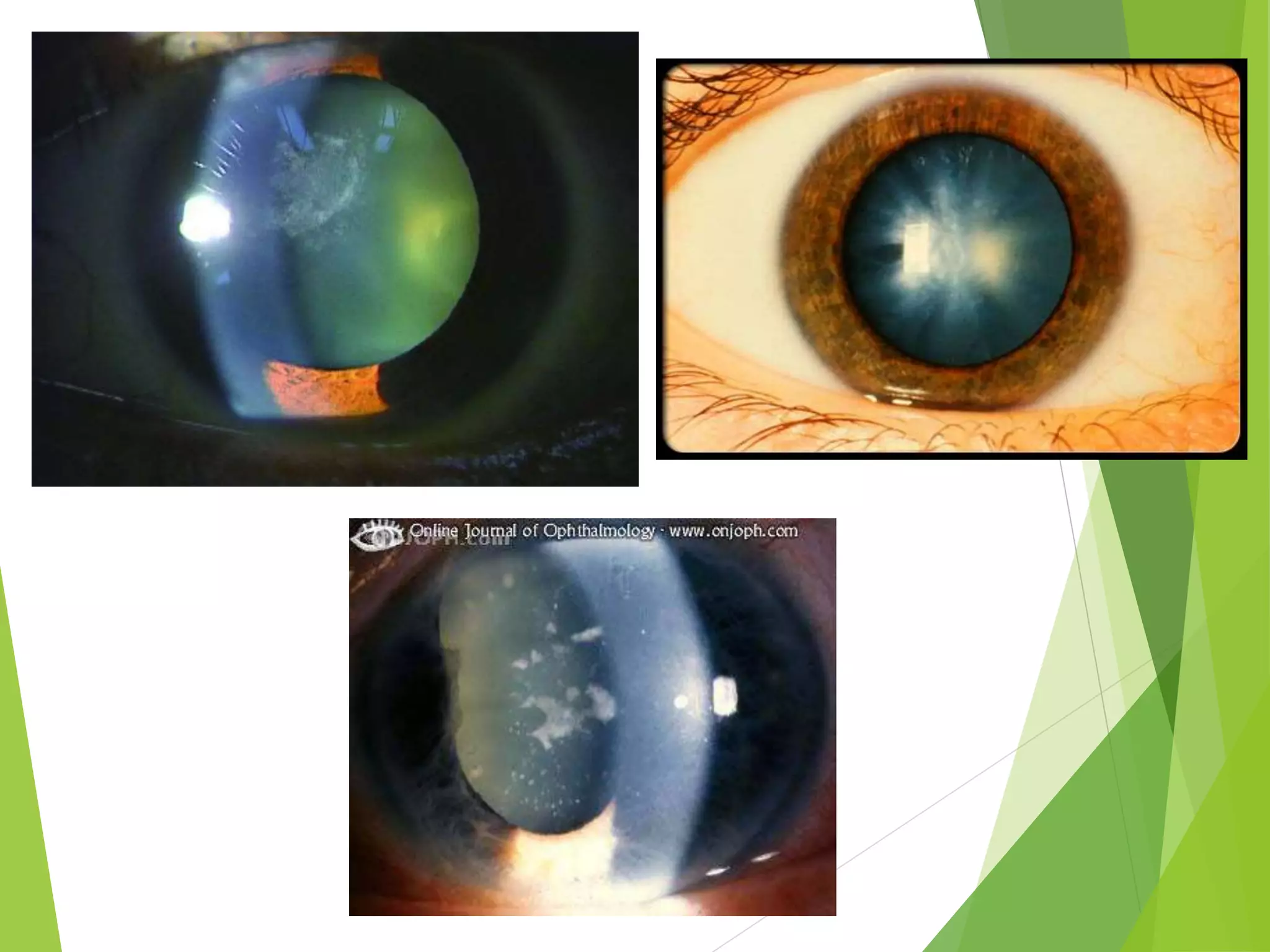 Anatomy of crystalline lens by Dr. Aayush Tandon | PPTX