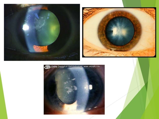 Anatomy of crystalline lens by Dr. Aayush Tandon | PPTX | Eye and ...