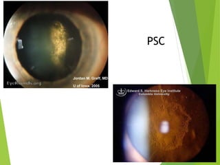 Anatomy of crystalline lens by Dr. Aayush Tandon | PPTX