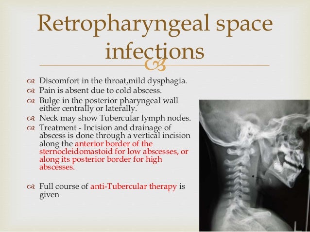 Retropharyngeal Abscess Anatomy Retropharyngeal Abscess Surgery ENT