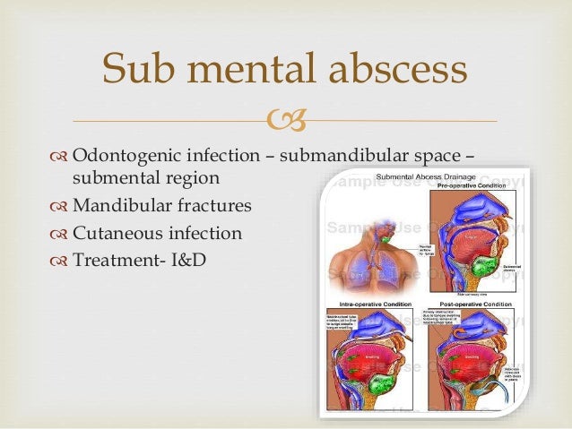 SURGICAL ANATOMY OF DEEP NECK SPACES