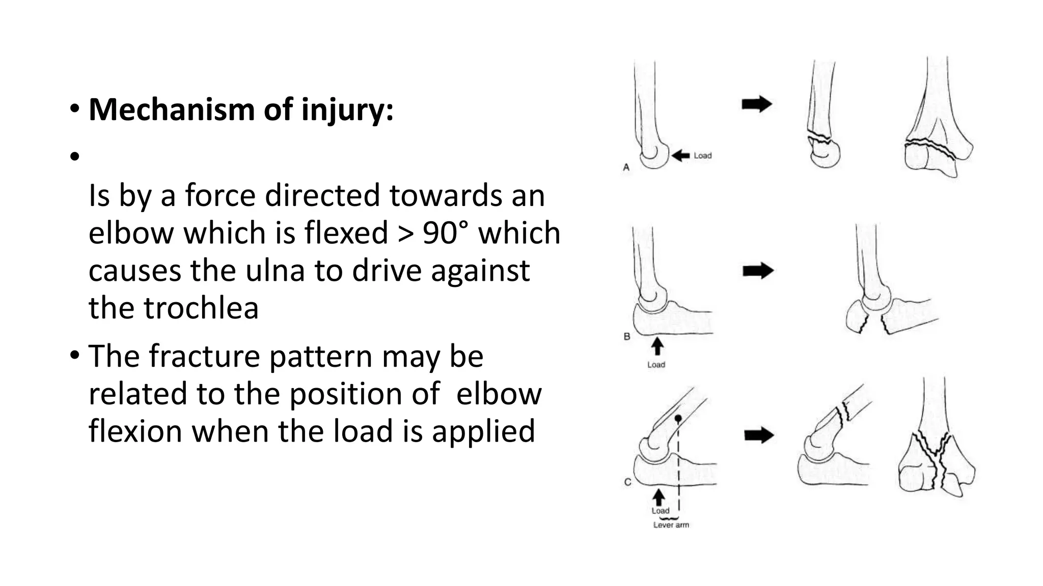 Anatomy of elbow and INTERCONDYLAR FRACTURE OF THE HUMERUS | PPTX