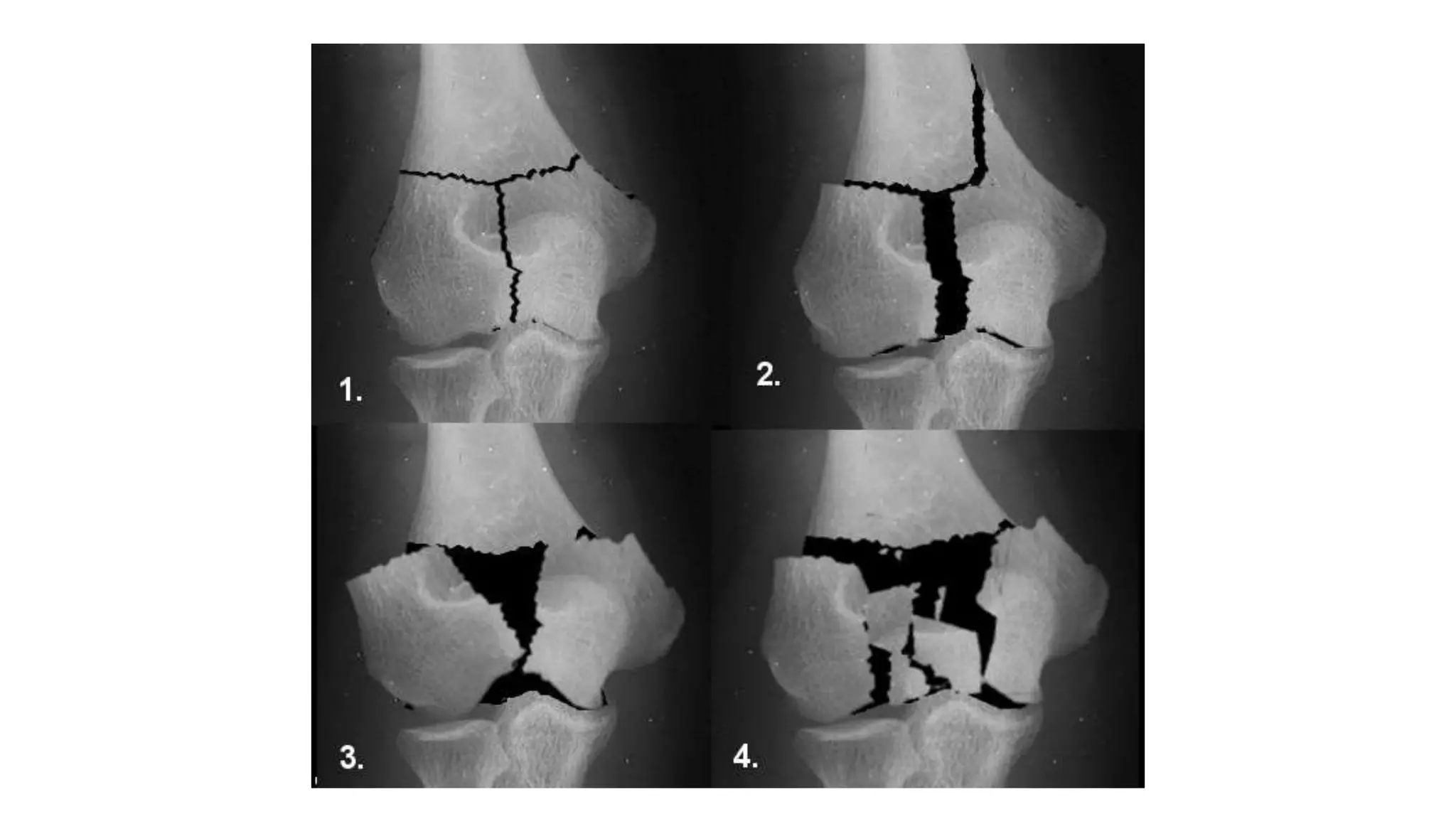 Anatomy of elbow and INTERCONDYLAR FRACTURE OF THE HUMERUS | PPTX