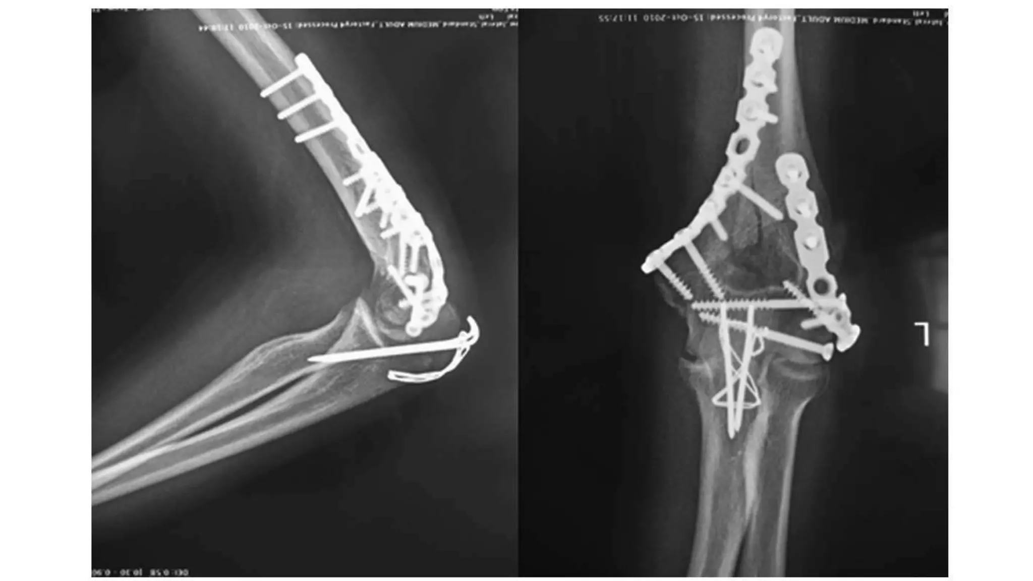 Anatomy of elbow and INTERCONDYLAR FRACTURE OF THE HUMERUS | PPTX