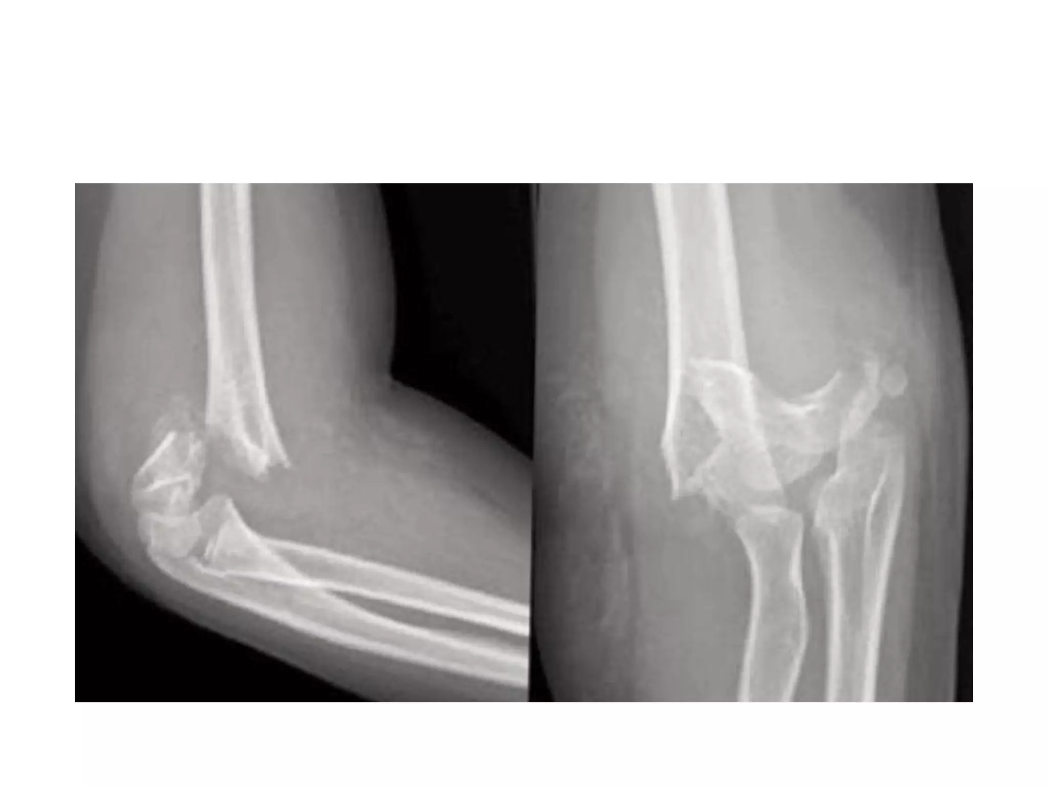 Anatomy of elbow joint | PPTX