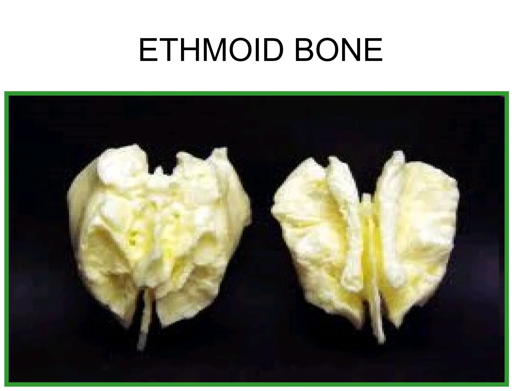 Anatomy of ethmoid bone and ethmoid sinus | PPT