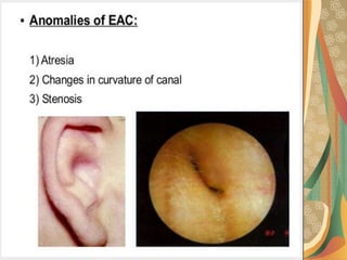 Anatomy of external ear | PPT | Ear, Nose and Throat Conditions ...