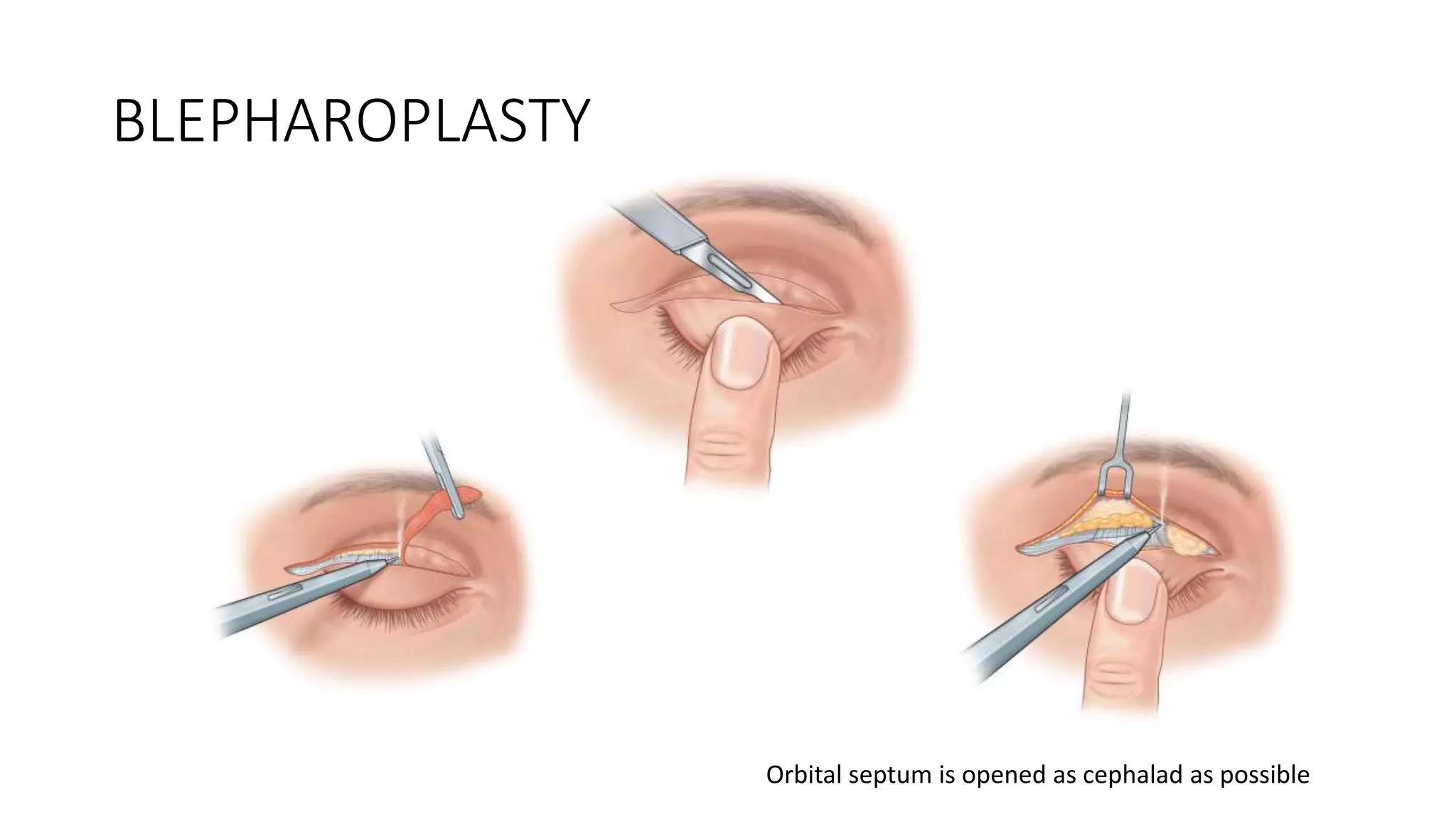 Anatomy Of Eyelid And Blepharoplasty.pptx