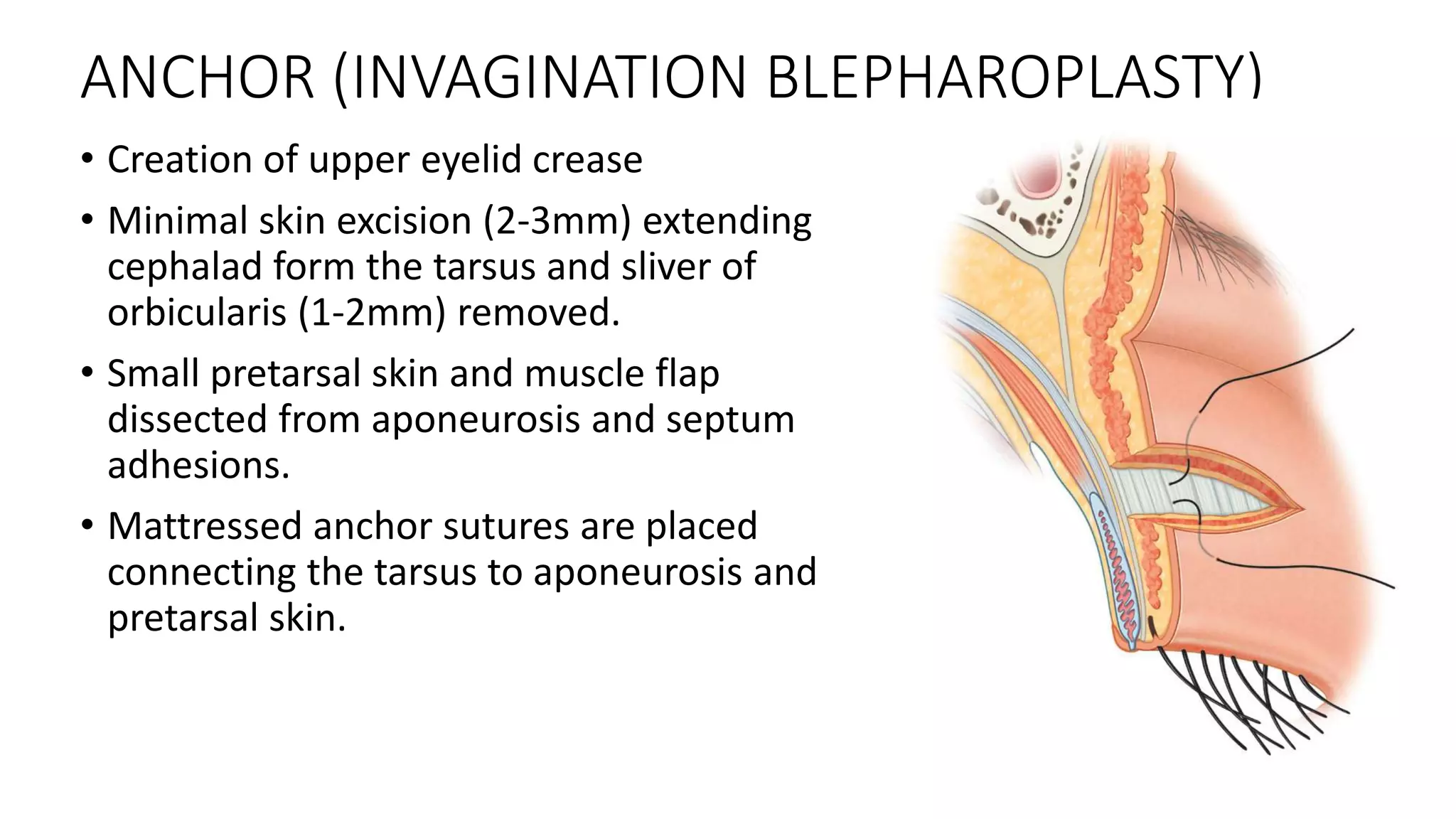 Anatomy Of Eyelid And Blepharoplasty.pptx