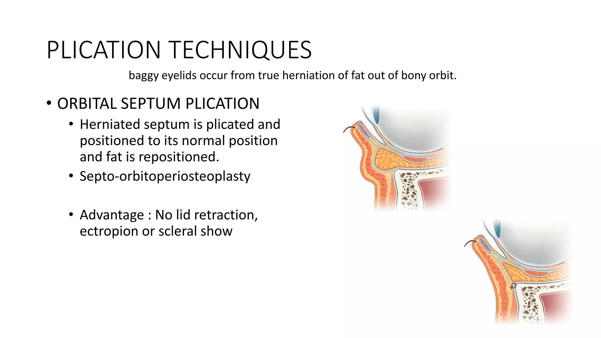 Anatomy Of Eyelid And Blepharoplasty.pptx