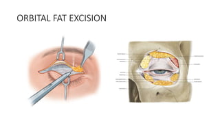 Anatomy Of Eyelid And Blepharoplasty.pptx