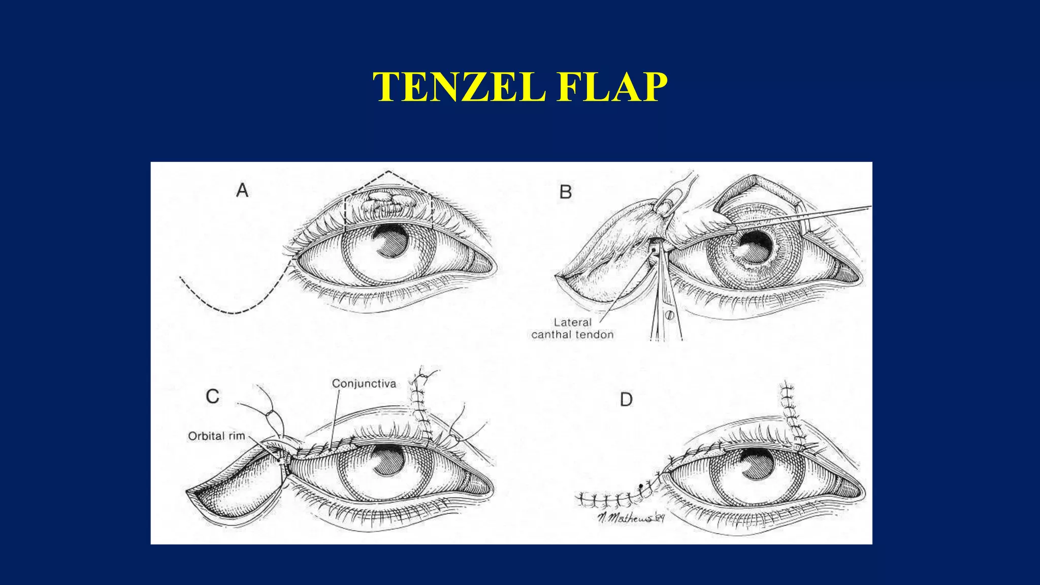 Anatomy of eyelid and eyelid reconstruction | PPTX