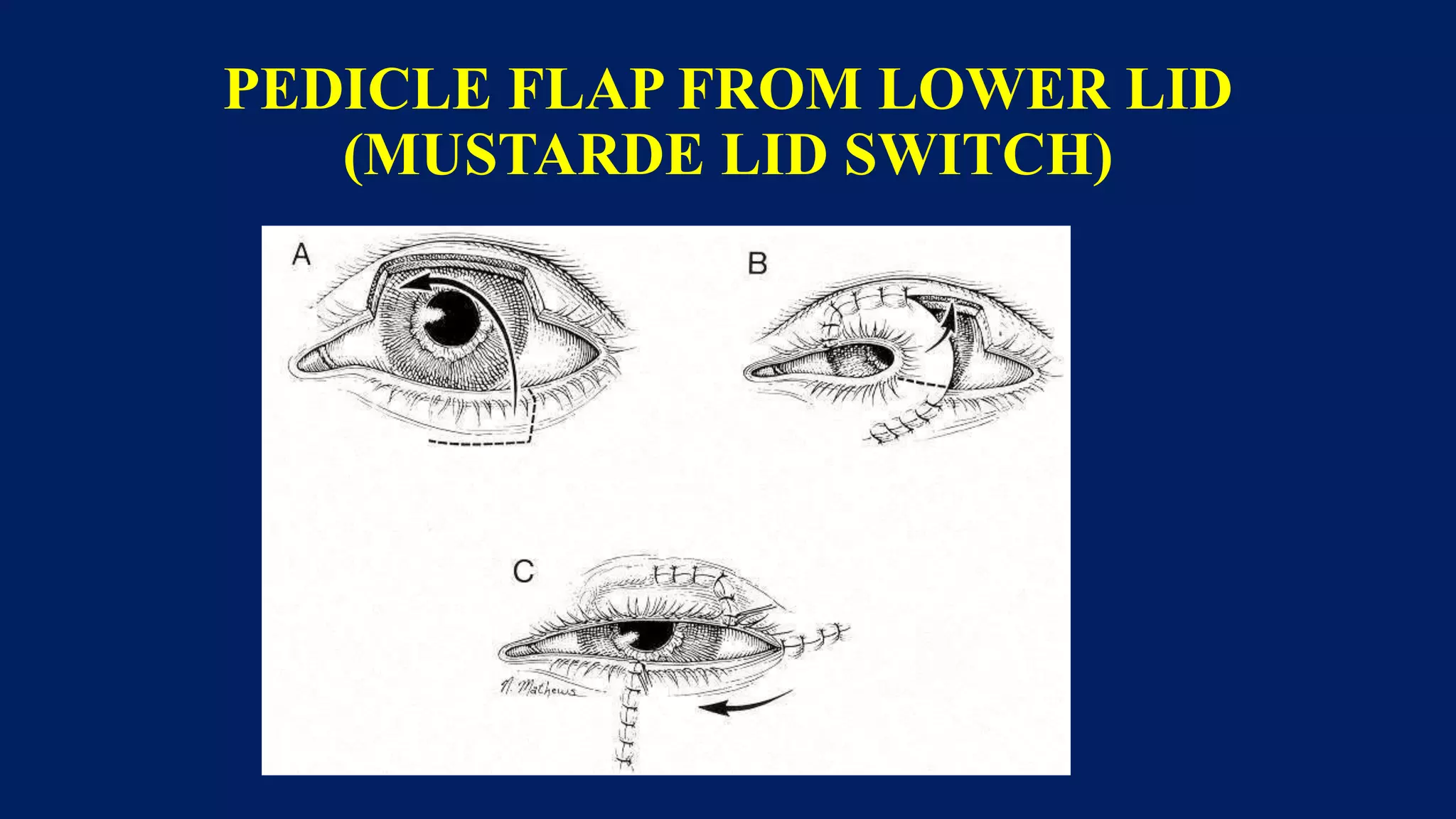 Anatomy of eyelid and eyelid reconstruction | PPTX