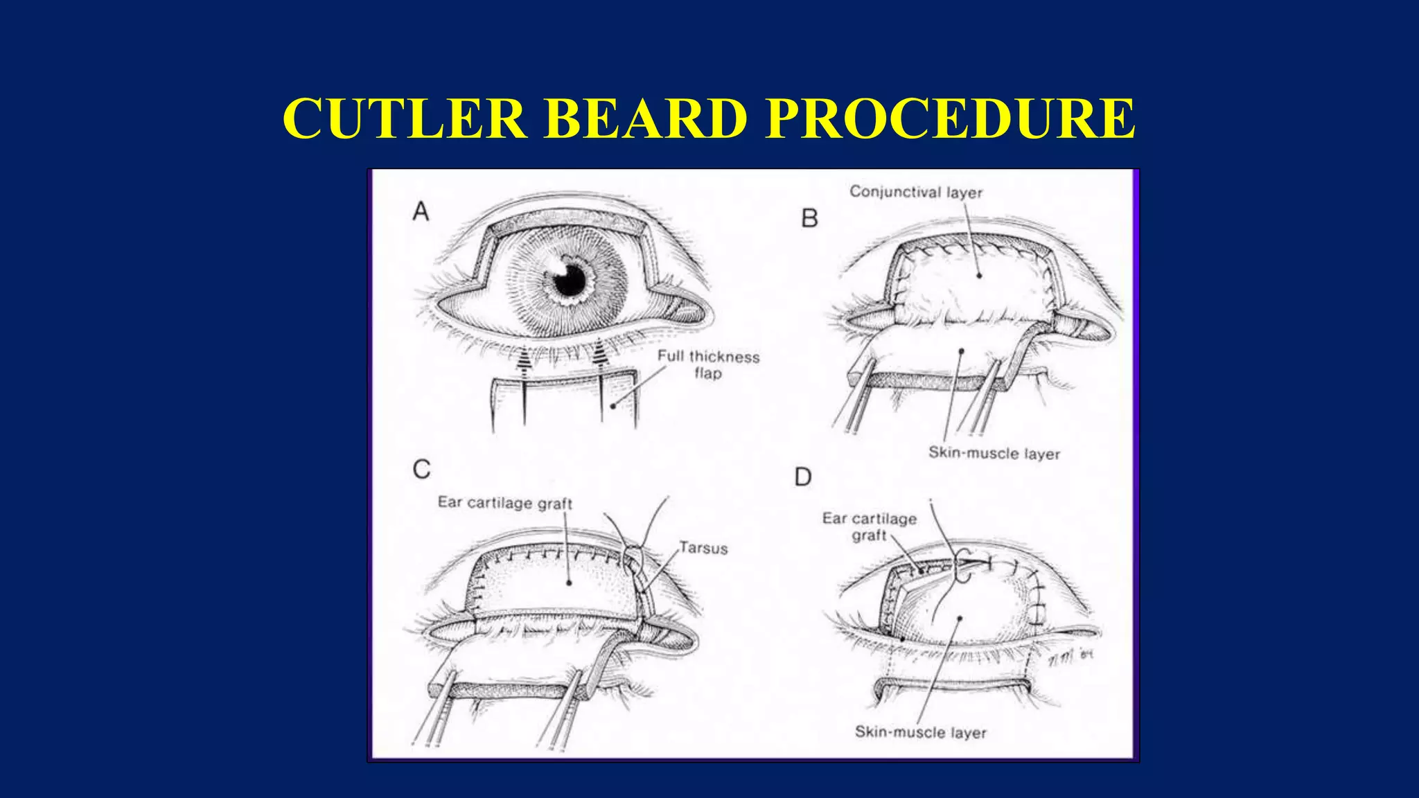 Anatomy of eyelid and eyelid reconstruction | PPTX