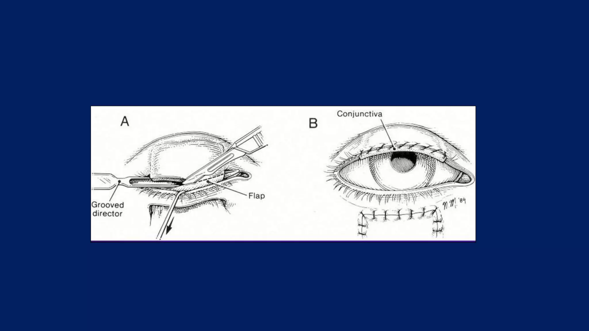 Anatomy of eyelid and eyelid reconstruction | PPTX