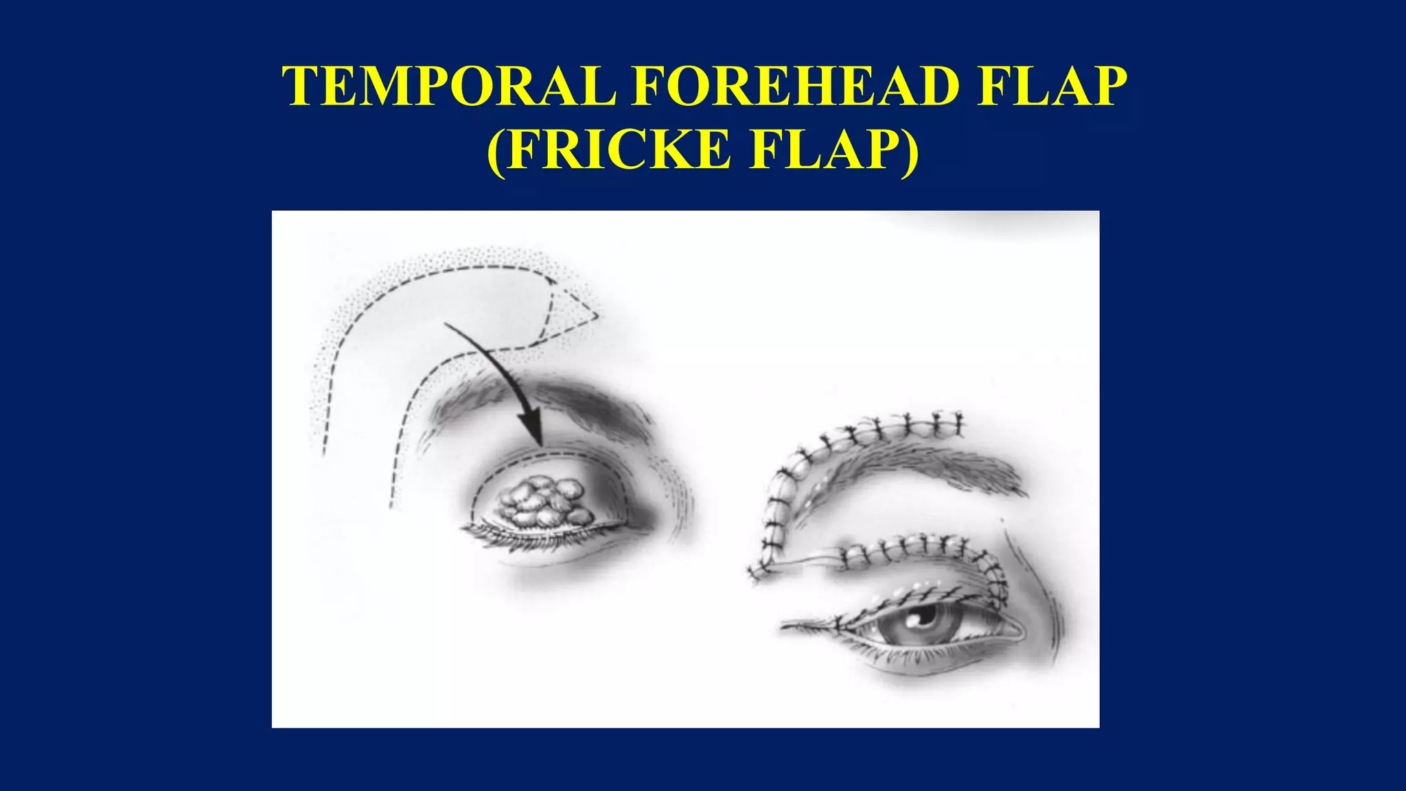 Anatomy of eyelid and eyelid reconstruction | PPTX