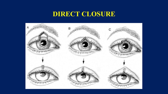 Anatomy of eyelid and eyelid reconstruction | PPTX | Eye and Vision ...