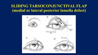 Anatomy of eyelid and eyelid reconstruction | PPTX