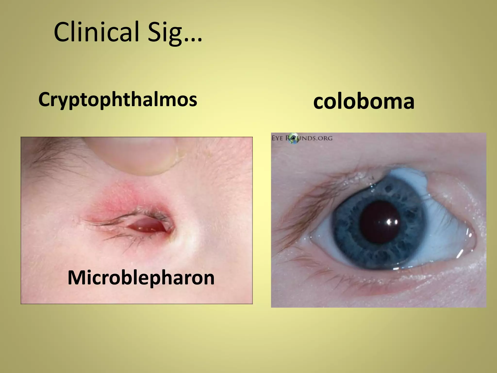 Anatomy of Eyelids & Its Clinical Correlations | PPTX