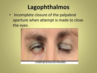 Anatomy of Eyelids & Its Clinical Correlations | PPTX