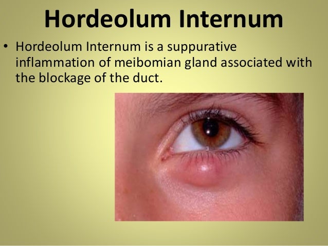 Anatomy of Eyelids & Its Clinical Correlations