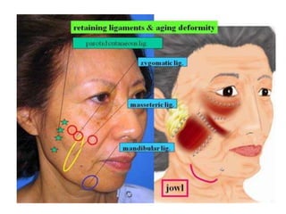 Anatomy of Facial Retinacula.ppt