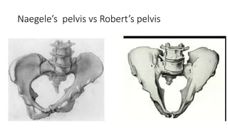 Naegeles Pelvis