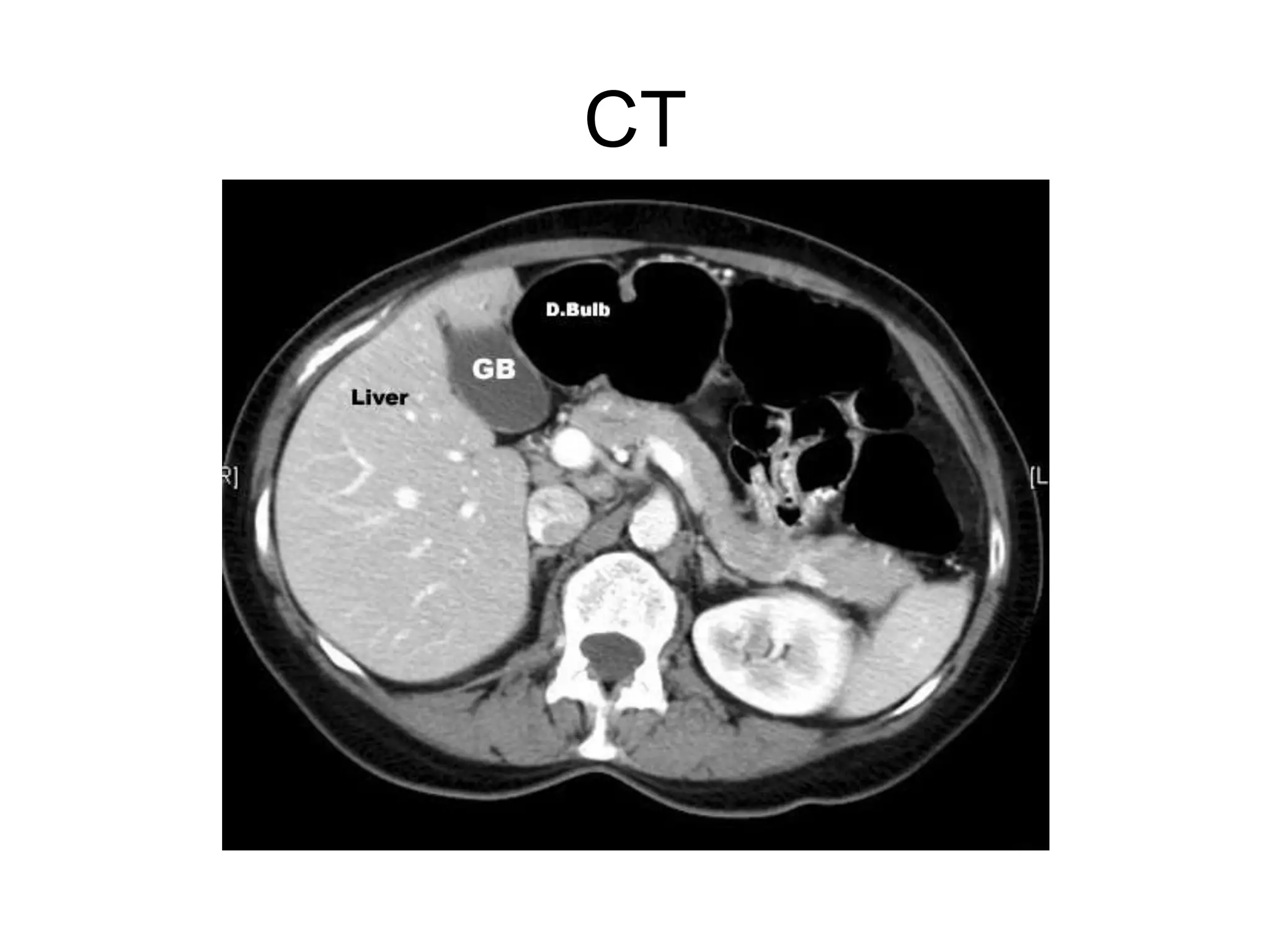 Anatomy of gall bladder | PPTX