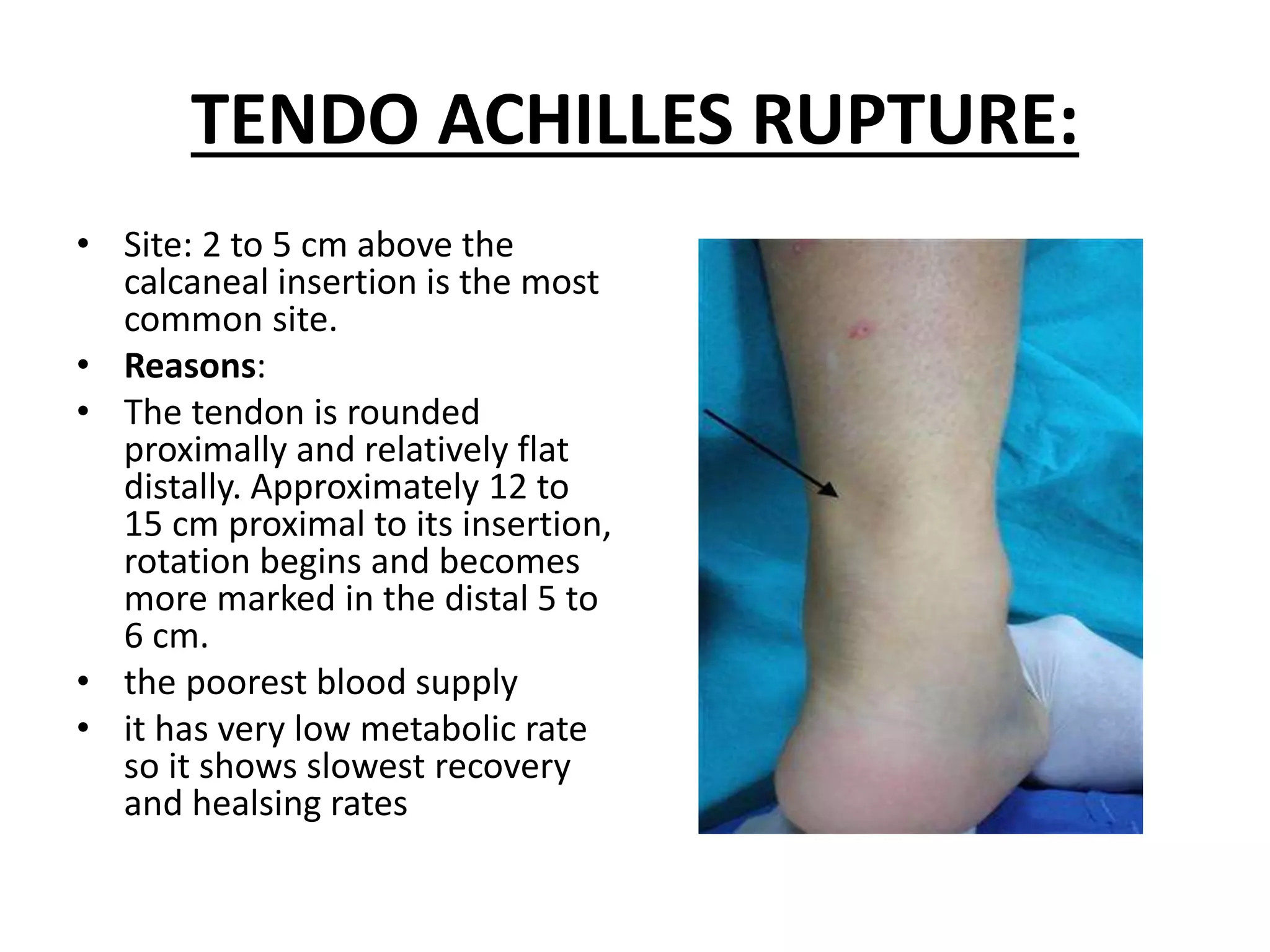 ANATOMY OF GASTROCSOLEUS COMPLEX AND TEAR OF TENDO.pptx