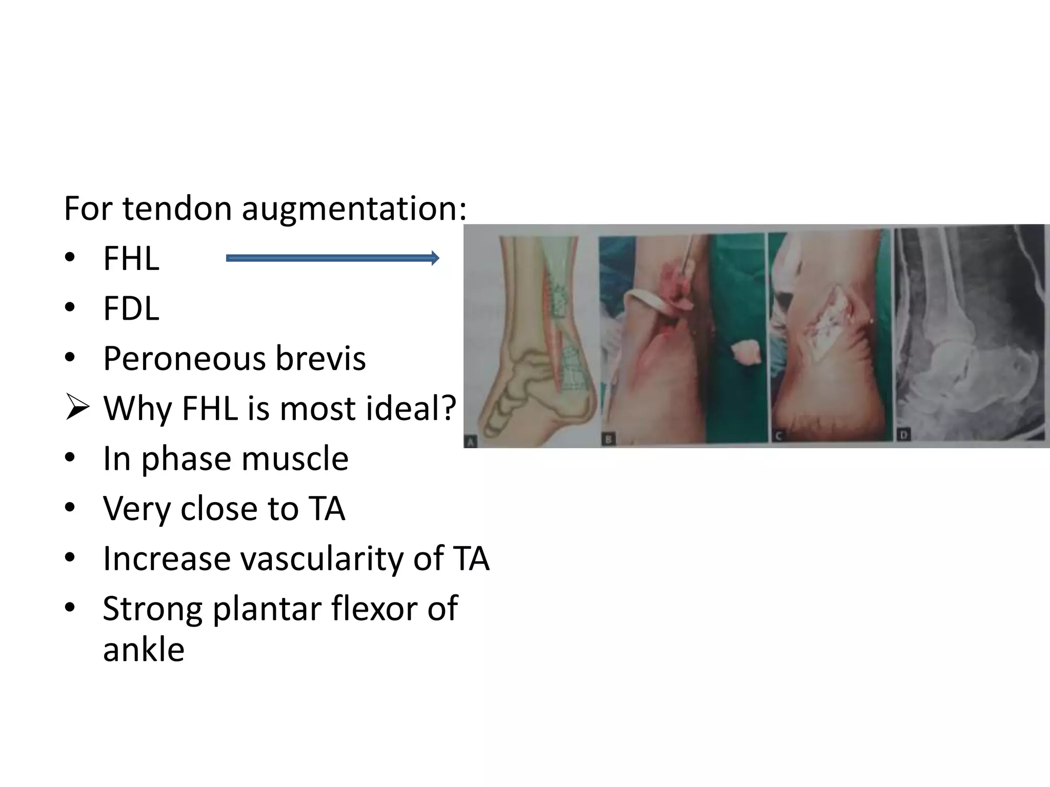 ANATOMY OF GASTROCSOLEUS COMPLEX AND TEAR OF TENDO.pptx