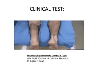 ANATOMY OF GASTROCSOLEUS COMPLEX AND TEAR OF TENDO.pptx