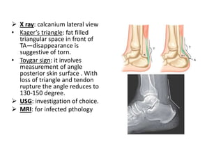 ANATOMY OF GASTROCSOLEUS COMPLEX AND TEAR OF TENDO.pptx | Death, Injury ...