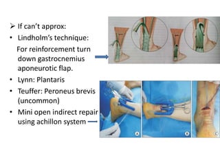 ANATOMY OF GASTROCSOLEUS COMPLEX AND TEAR OF TENDO.pptx