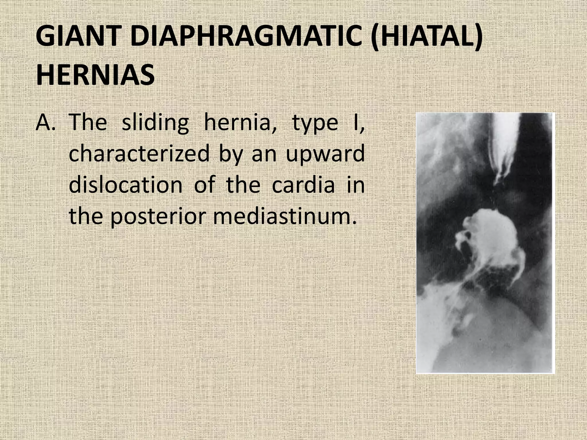 Anatomy of gastroesophagial junction with specail reference to hiatus ...
