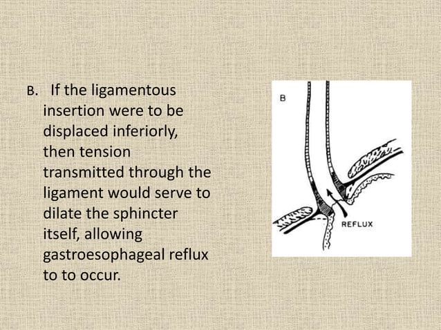 Anatomy of gastroesophagial junction with specail reference to hiatus ...