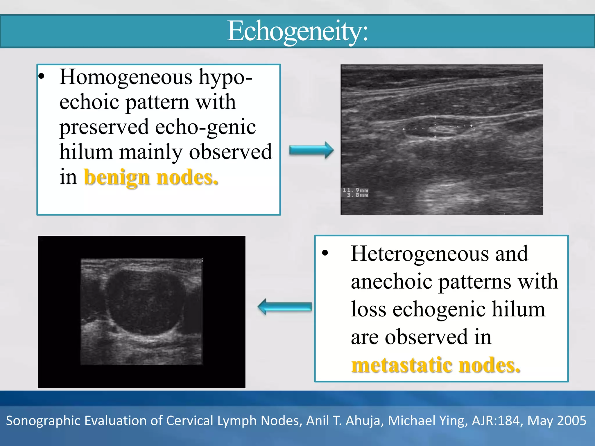 Lymph nodes of head & neck, Normal anatomy and its applied aspect | PPTX